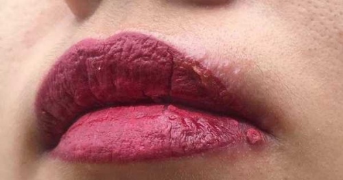 Cảnh báo: Biến chứng săm môi tại cơ sở thẩm mỹ không an toàn